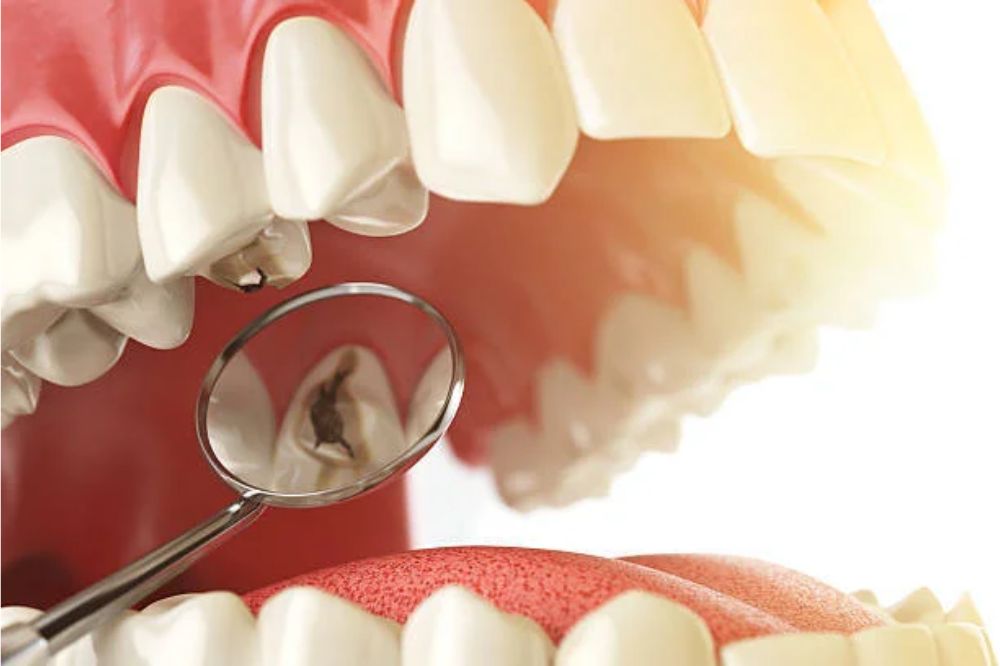 What Are the Steps in Dental Fillings? - Garden Oaks Dental